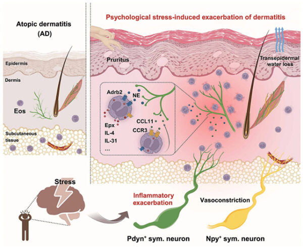 Scientists Uncover The Nerve Pathway That Makes Stress Worsen Eczema ...