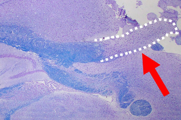 Promising Anti-Aging Drug May Cause Brain Damage, Scientists Warn ...