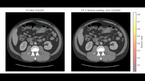 AI Can Spot Pancreatic Cancer Years Before Diagnosis, Study Finds ...