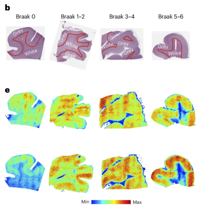 A Supplement For Joint Pain Could Accelerate Alzheimer's Memory Loss ...