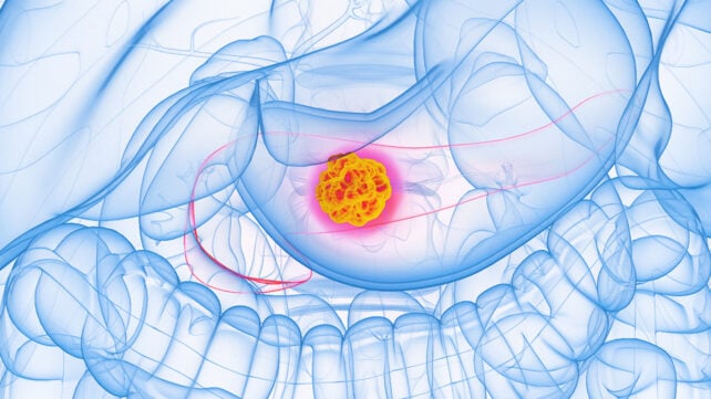 Experimental Drug Stops 90% of Pancreatic Cancer Cell Spread in Lab ...