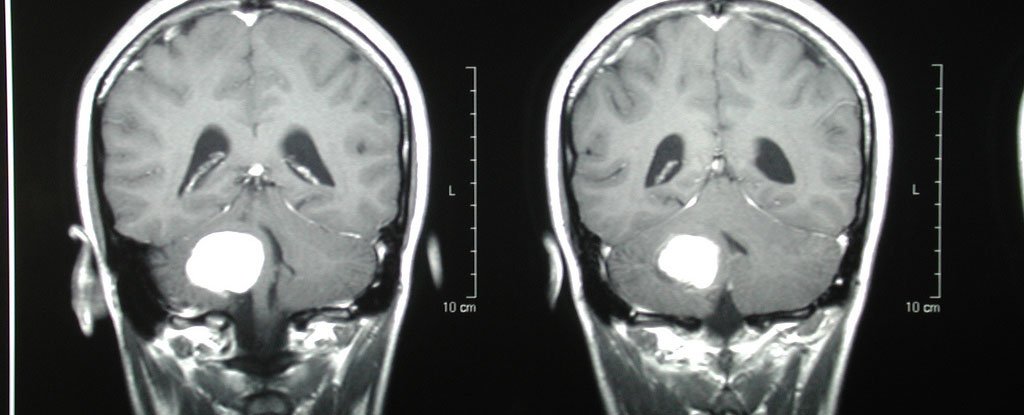 Scientists Just Made Big Progress in Fighting This Incurable Form of ...