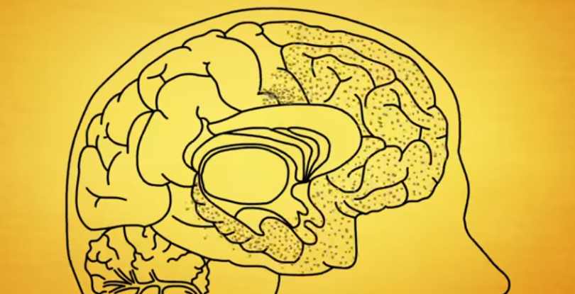 WATCH: This Is Exactly What Alzheimer's Does to The Brain : ScienceAlert