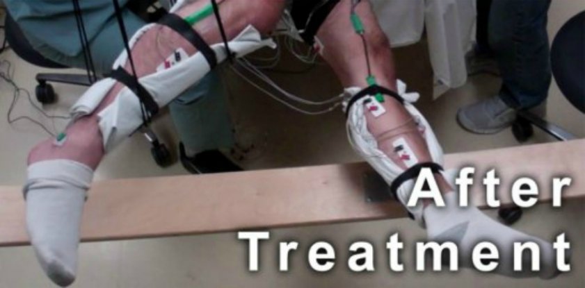 Paralysed Patients Take Small Steps Thanks to a Non-Invasive New ...