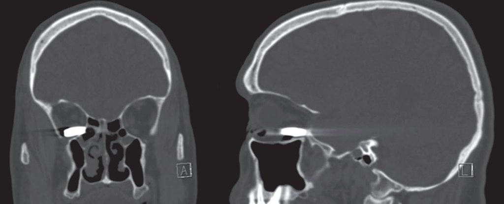This Dramatic Photo Shows a .22 Calibre Bullet Lodged in a Man's Eye ...