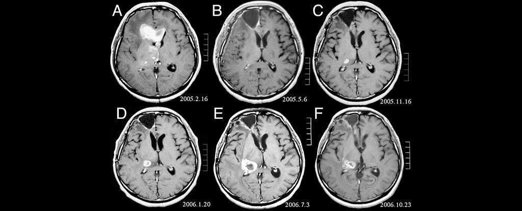 Largest Ever Brain Cancer Study Provides Key Insight Into One of Its ...