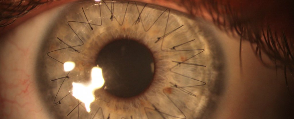 Whoa, This Is What Eyeball Stitches Look Like : ScienceAlert