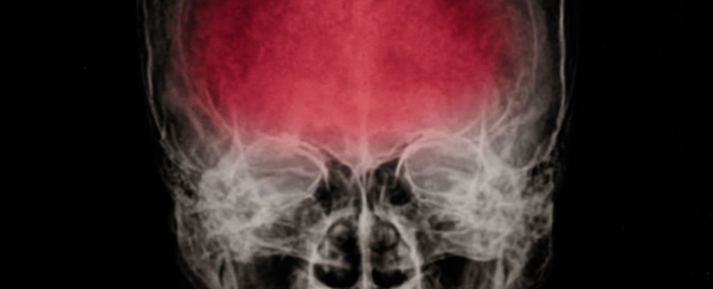 Early Treatment For Brain Inflammation Could Prevent Schizophrenia ...